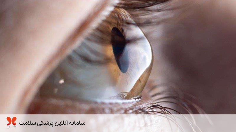 قوز قرنیه چشم / علت به وجود آمدن قوز قرنیه و درمان آن | مجله سلامت حال